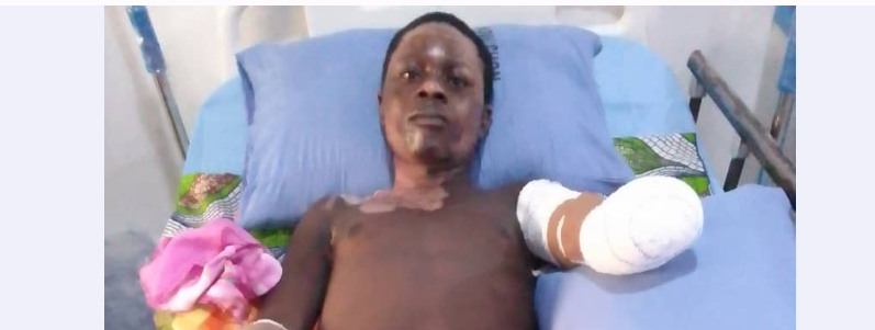 INSIDE LIFE: Taraba Poly student loses both hands after electrocution while hoisting PDP flag ...